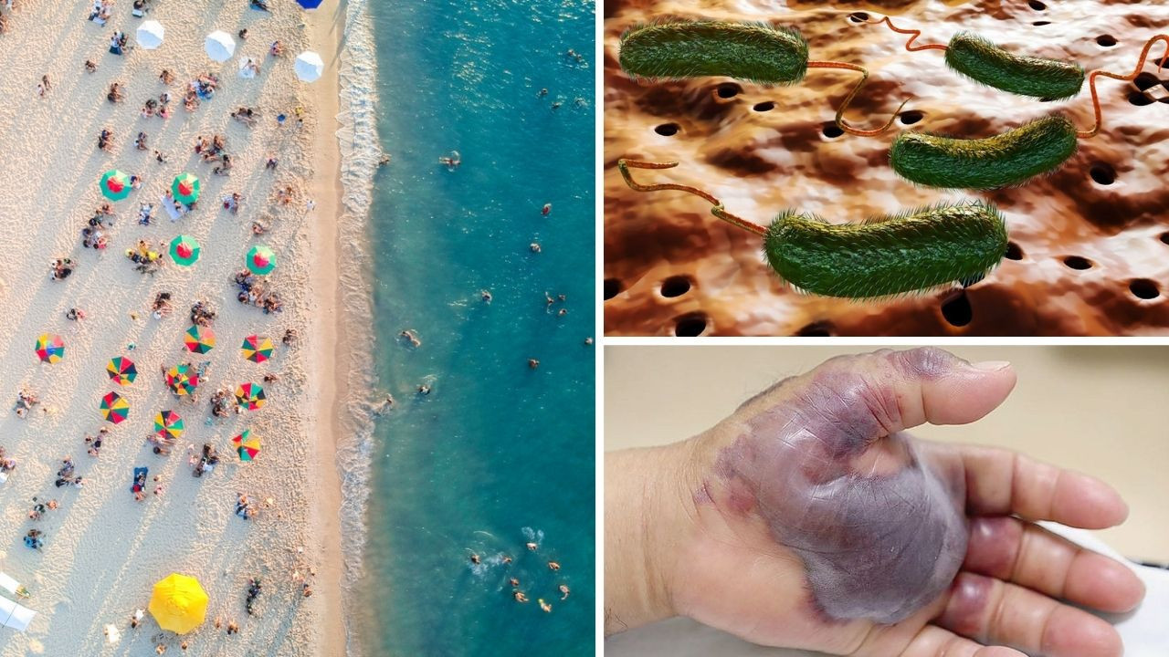 Plajlarda 'et yiyen bakteri' paniği: Enfekte her 5 kişiden 1'i...